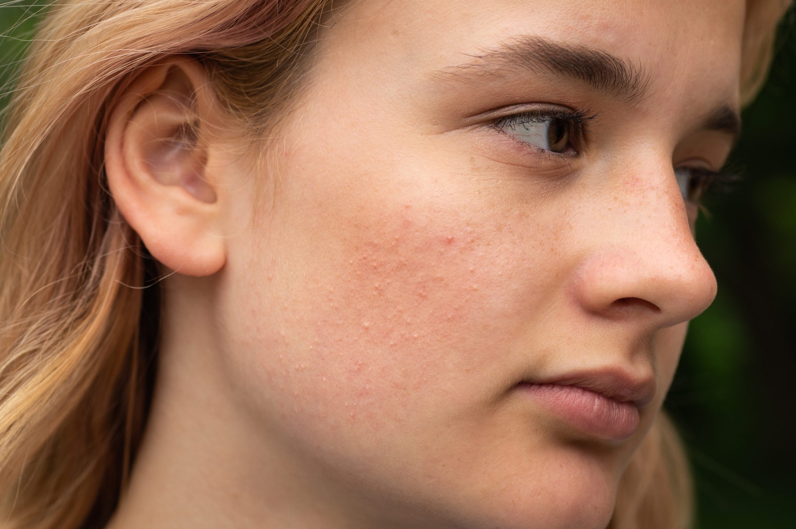 Rosacea Bumps On Nose Itchy Bumps On Face Cheeks Thinner My XXX Hot Girl Rosacea Bumps On Nose Itchy Bumps On Face Cheeks Thinner My XXX Hot Girl